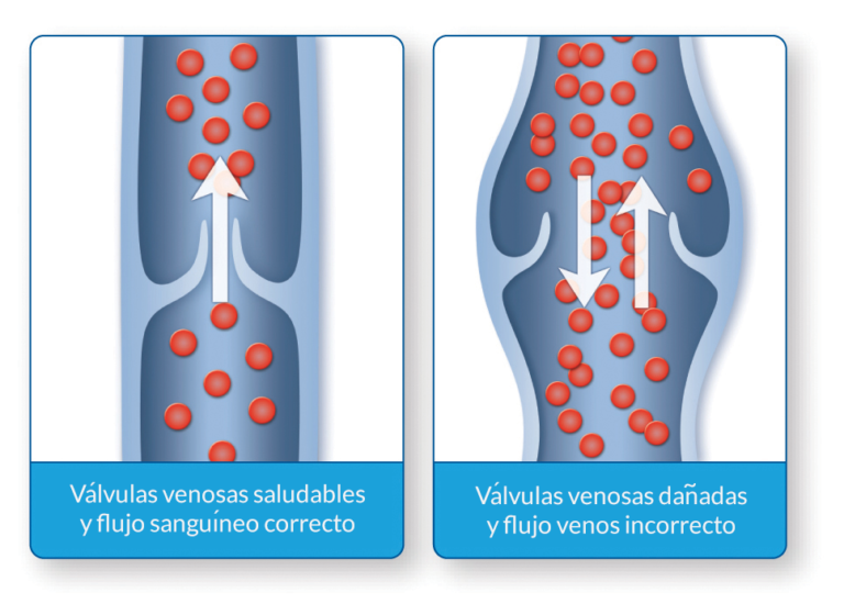 Enfermedad Venosa — Medical Vein Clinic