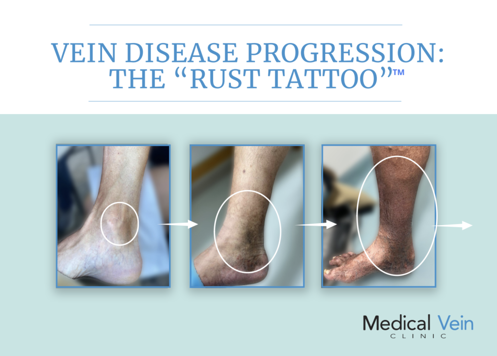 What is Lipedema? | Medical Vein Clinic