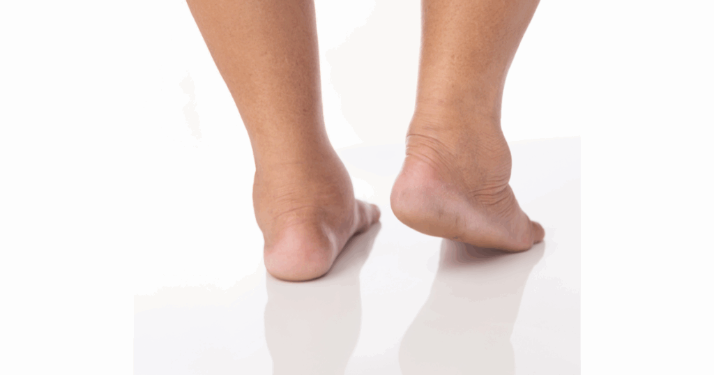 Lipedema vs. Lymphedema: Key Differences, Symptoms, and How to Get the ...