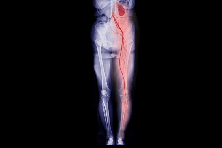 The 5 P’s of Peripheral Artery Disease: What Your Body’s Trying to Tell ...